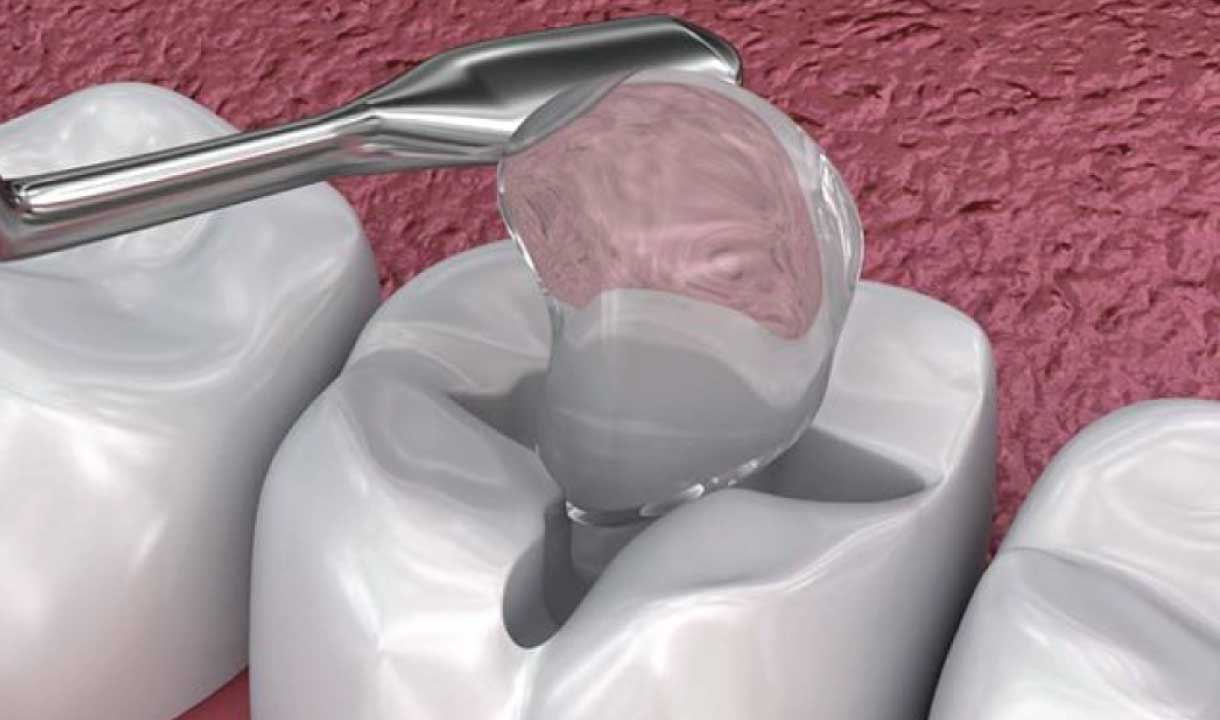 Filling | Lifemed Dental