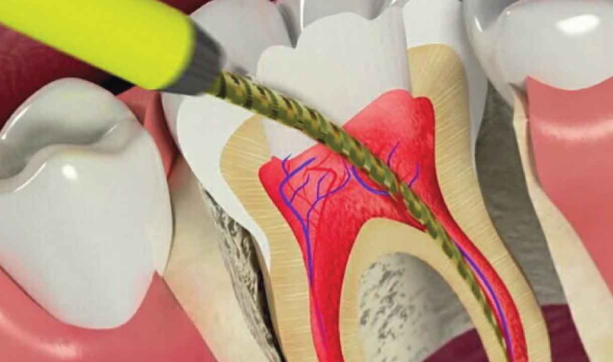 Root Canal Treatment (Endodontics) | Lifemed Dental